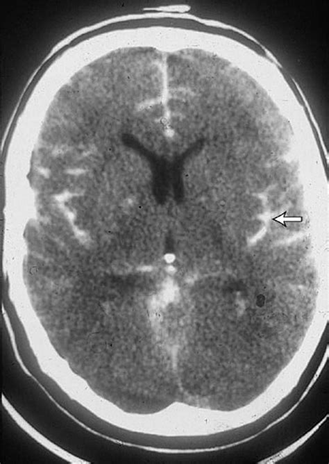 Subarachnoid Hemorrhage Neurologic Disorders Msd Manual