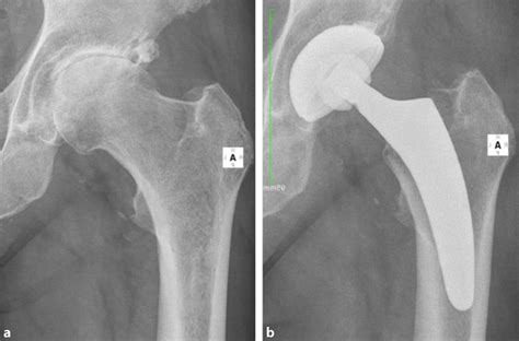 8 Varus Alignment The Short Stem Aligns Itself According To The