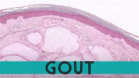 Pretibial Myxedema Pathology
