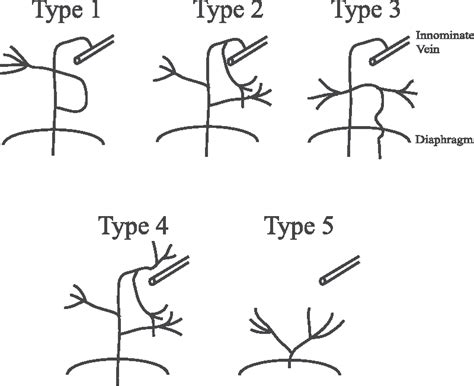 Figure 2 From Percutaneous Lymphatic Embolization Of Abnormal Pulmonary