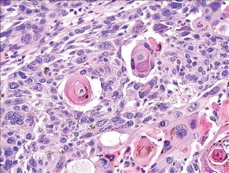 Tumor With The Features Of Both Squamous Cell Carcinoma And Melanoma