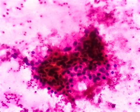 Adjuvant Nivolumab Vs Placebo In Localized Renal Cell Carcinoma At High