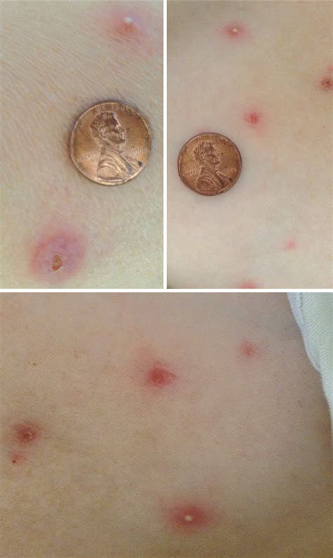 Crohns Disease Skin Symptoms