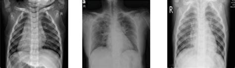 1 Sample Of Cxr Images Download Scientific Diagram