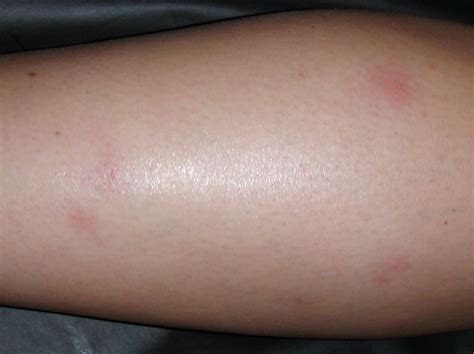 Bed Bug Bite On Leg