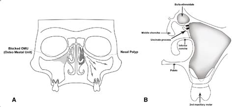 Coronal Ct Scan Showing An Accessory Maxillary Sinus