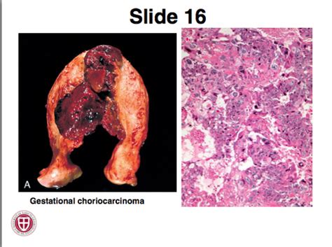 Choriocarcinoma Gross Image
