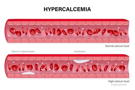 Hypercalcemia
