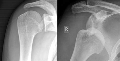 Shoulder Dislocation And Instability Treatment Dr Sara Jurek