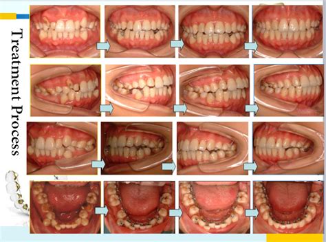 Step By Step Better And Better Lingual Bracesebrace Teeth Braces