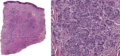 Cutaneous Metastases Diagnostic Histopathology