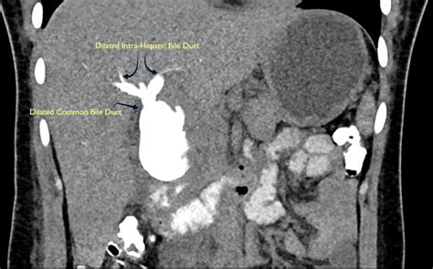 Type Iv‐a Choledochal Cyst With Choledocholithiasis In An Adult Female A Case Report