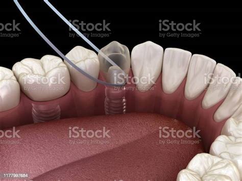 치실이있는 임플란트 치아 청소 의학적으로 정확한 3d 일러스트레이션 0명에 대한 스톡 사진 및 기타 이미지 0명 건강관리와 의술 디지털 생성 이미지 Istock