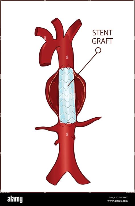 Thoracic Aortic Aneurysm