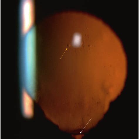 Fundus Photograph With Choroidal Coloboma I Two Patches Of Coloboma