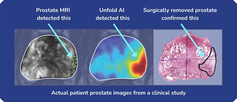 unfold ai avenda health precision prostate cancer treatment