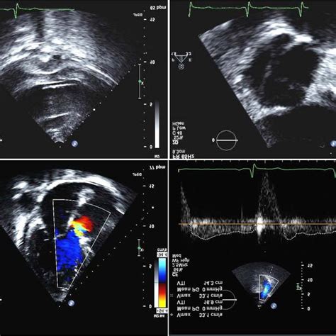 A Transthoracic Echocardiogram With Color Flow Doppler Apical Download Scientific Diagram