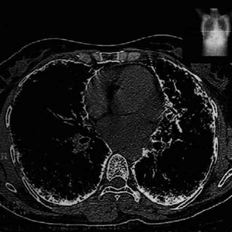 Pdf Pulmonary Alveolar Microlithiasis
