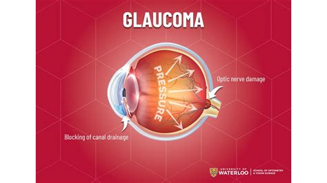 Ce Este Glaucomul Onioptic Medical