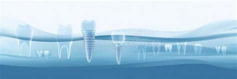 Detailed Cross Section Of A Tooth Implant Showing Components Within The