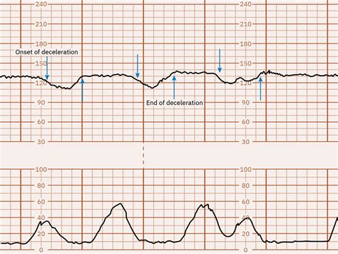 162 Basic Terms Of Fetal Heart Rate And Contraction Patterns Medicine Libretexts 162 Basic Terms Of Fetal Heart Rate And Contraction Patterns Medicine Libretexts