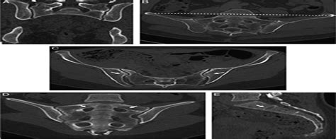 Sacral Dysmorphism And Its Implication On The Size Of The Sa Clinical Spine Surgery