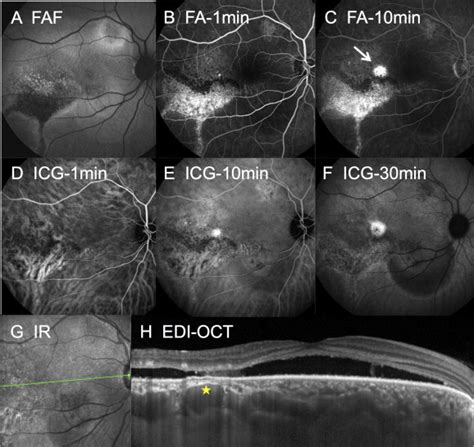 Multimodal Imaging Of Active Chronic Cscr In The Right Eye Of A 45 Year