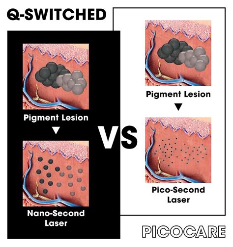 Pico Laser And Traditional Laser Cambridge Medical Group