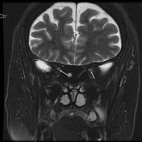 CSF Cell Count And Differential Download Scientific Diagram