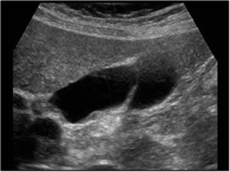 Abdomen And Retroperitoneum 12 Gallbladder And Bile Ducts Case 12