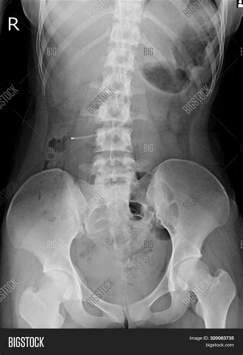 Pacemaker X Ray Image Image And Photo Free Trial Bigstock