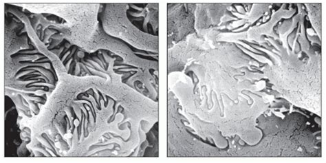 Diffuse Mesangial Sclerosis Basicmedical Key