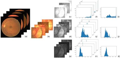 Figure 1 From Fully Automated Method For Glaucoma Screening Using Robust Optic Nerve Head
