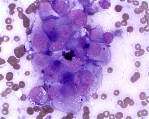 Amelanotic Melanoma Cytology