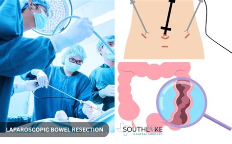 Laparoscopic Bowel Resection Your Recovery Guide Southlake General Surgery