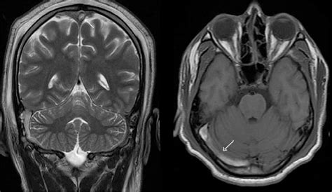 Magnetic Resonance Imaging Brain Showing Loss Of Flow Void With High