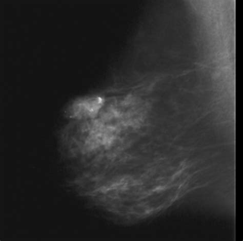 Clustered Coarse Heterogeneous Microcalcifications Associated With A