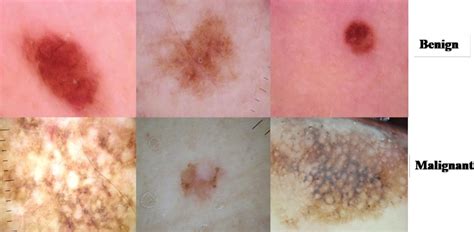 Figure 4 From Detection Of Skin Cancer Based On Skin Lesion Images