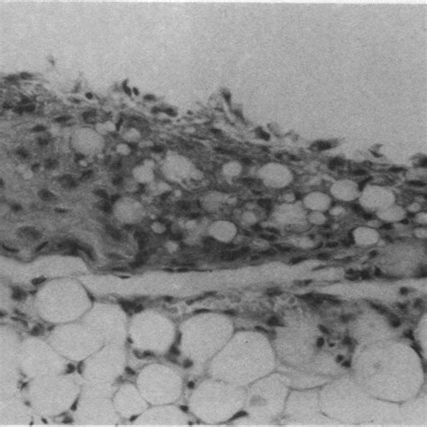 Synovium One Week After Perfusion Ofjoint With Cold Silicone Showing