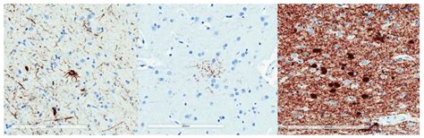 P Tau At8 Immunohistochemical Stains Demonstrate A Tufted Astrocyte