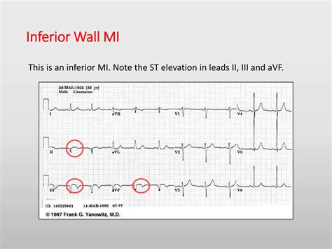 Skill Ecg 1 Ischemia For Students Pptx