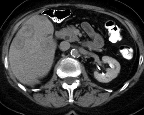 Radiation Therapy Yttrium 90 Radiation Therapy