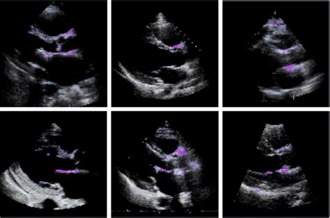 Echo Ai Model For Cac Scoring Cardiac Wire