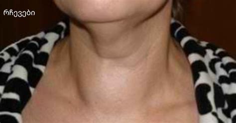 ფარისებრი ჯირკვლის ჩიყვი სიმპტომები და მკურნალობა ხალხური საშუალებებით