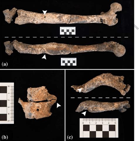 A Left Femur With Severe Osteomyelitis And Cloaca Upper Anterior