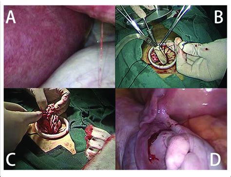 Extracorporeal Cystectomy Procedure A The Intraoperative View Download Scientific Diagram
