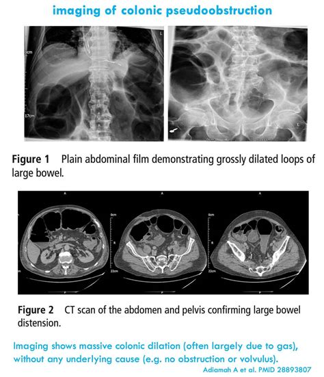 Acute Colonic Pseudo Obstruction Acpo Oglivies Syndrome Emcrit