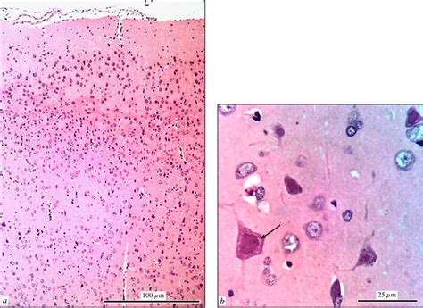 Microphotographs Of The White Rat Brain Sensorimotor Cortex 1 Day After