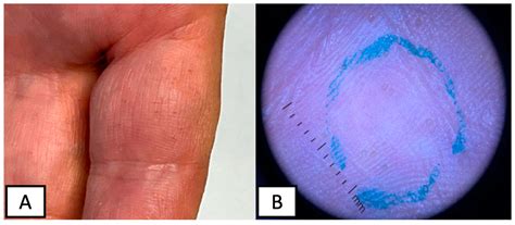 Spiny Keratoderma In Association With Melanoma Spiny Keratoderma In Association With Melanoma