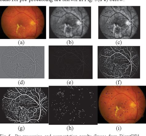 Figure 5 From Automatic Detection Of Microaneurysms In Retinal Fundus